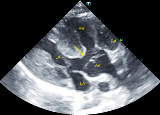 1 Ventricular Septal Defect (VSD) Feline SDEP 1 Long Axis[1] copy ...